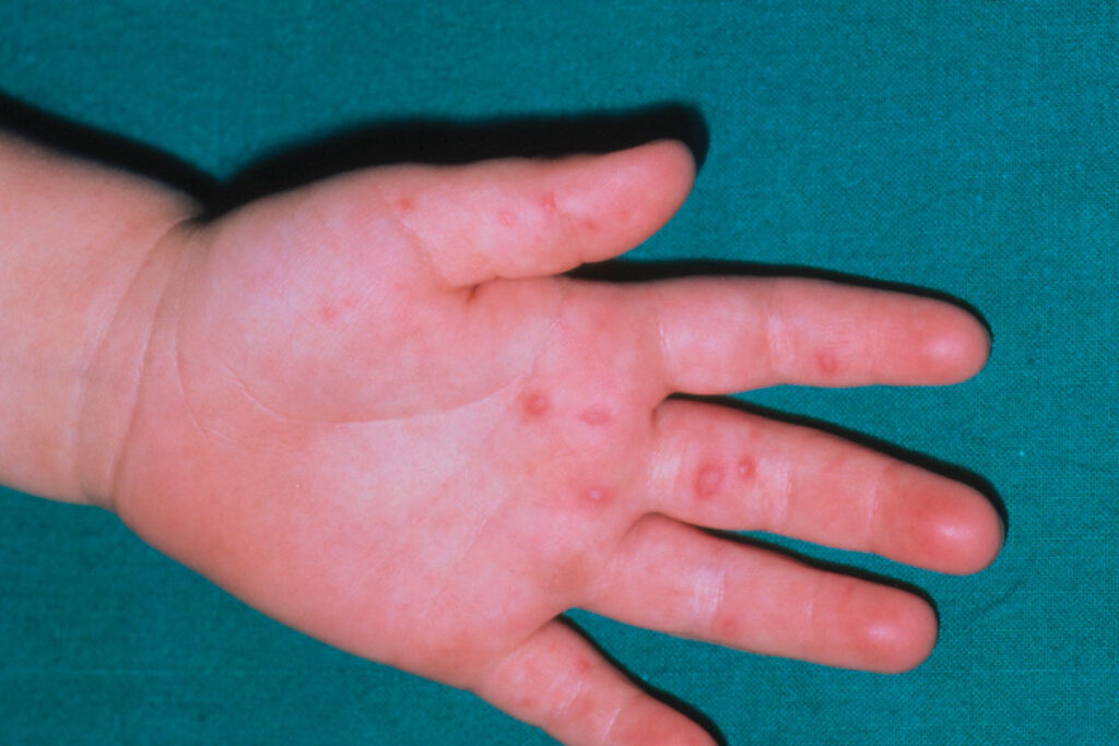 Medical arithmetic: unusual skin lesions on the hand, finger and arm ...