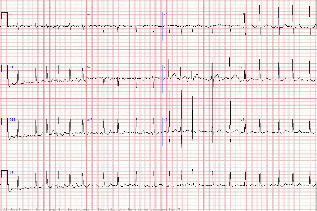 ECG quiz: Palpitations, irregular pulse on diabetic review and ...