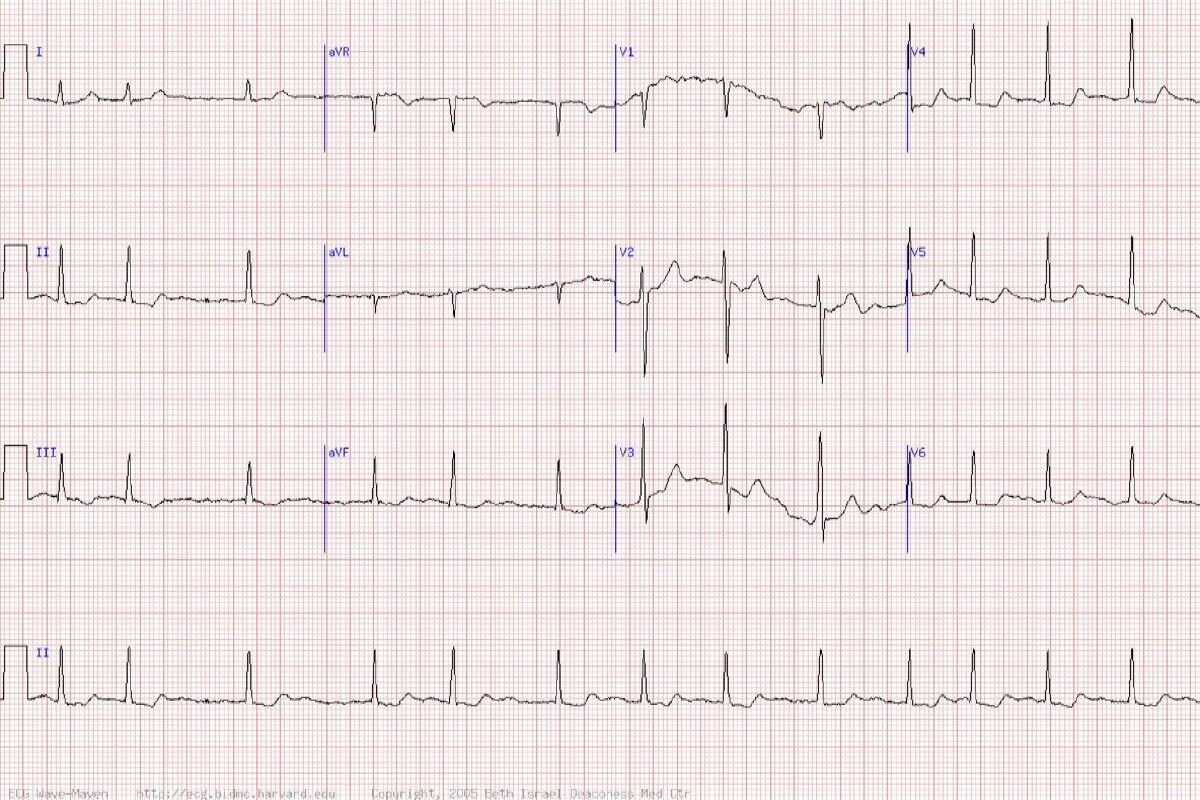 Stabbing pains and suspected heart failure: What could these ECGs mean ...