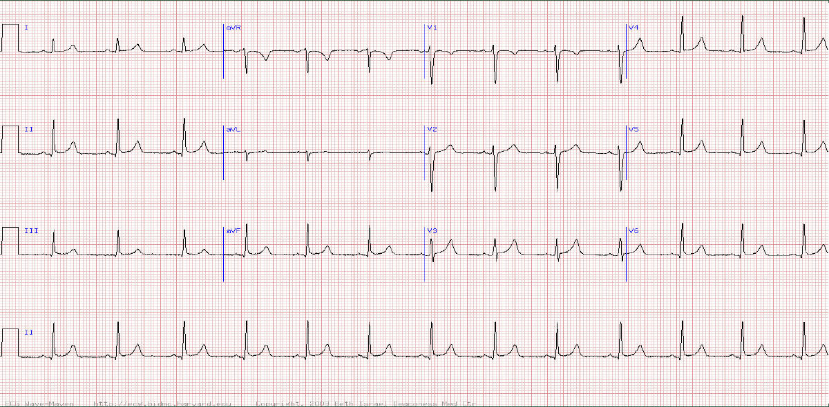 Stabbing pains and suspected heart failure: What could these ECGs mean ...