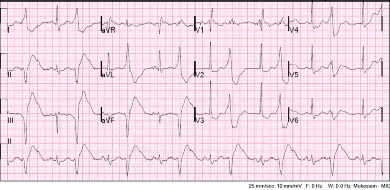 ECG quiz: What do these extra QRS complexes mean? - Pulse Today