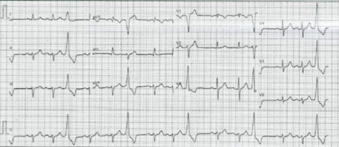 ECG quiz: What do these traces of palpitations indicate? - Pulse Today