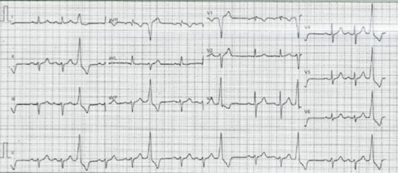 ECG quiz: What do these traces of palpitations indicate? - Pulse Today