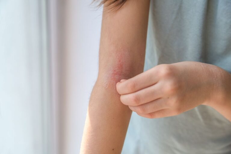Eczema: Myths and Facts - Pulse Today